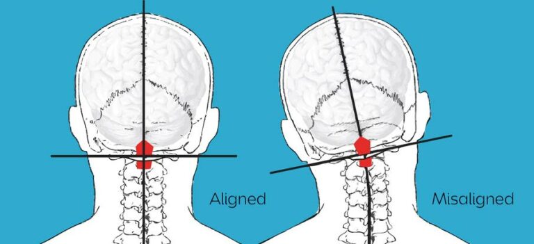 Is Your Head On Straight? - EPIC Clinics